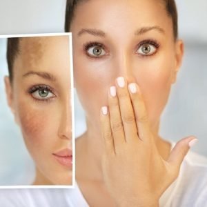 Does Skin Whitening Injections work for hyperpigmentation