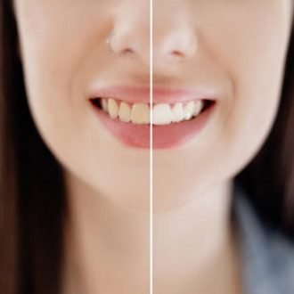 Why are my teeth yellow? - SKN Cosmetic & Plastic Surgery Clinic in ...