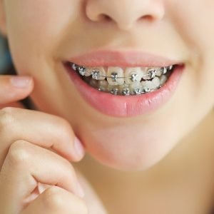 Does dental braces affect our face look?