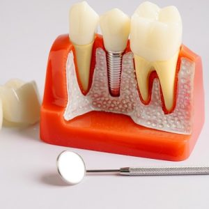 Is a crown necessary after root canal treatment? - SKN Cosmetic ...
