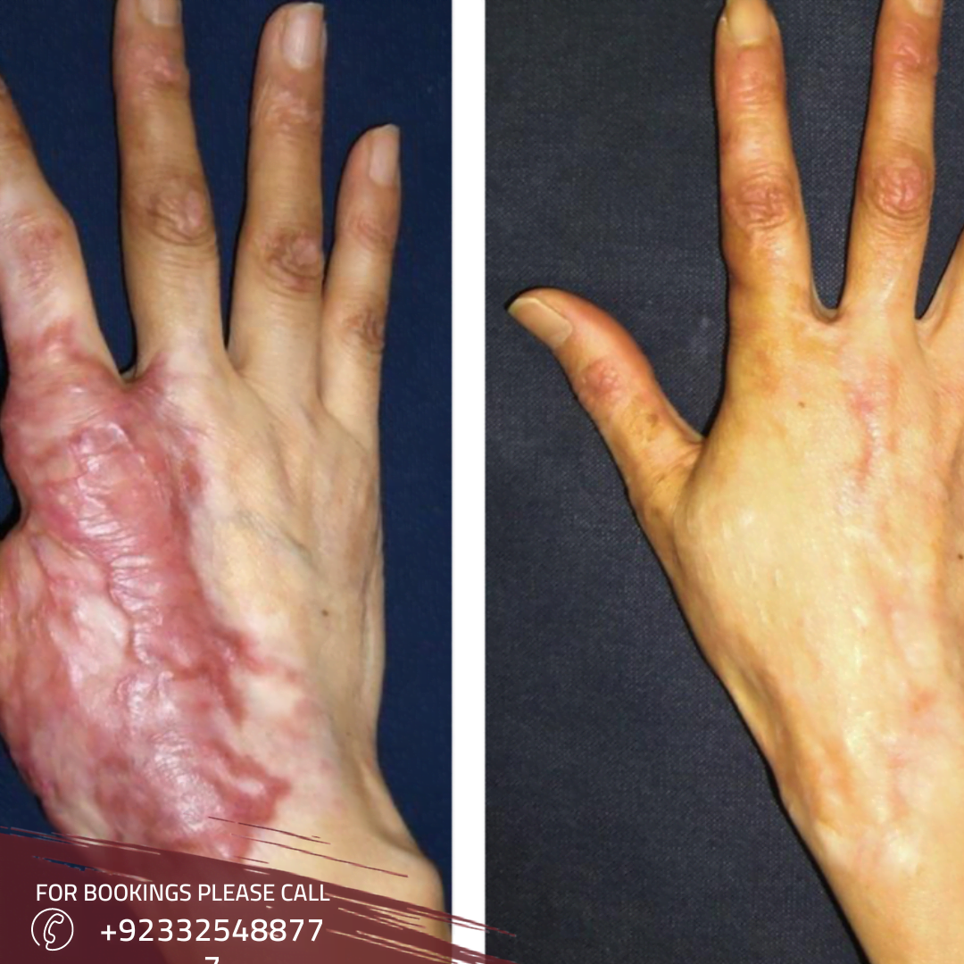 Burn & Reconstruction Surgery Clinic In Islamabad - SKN Cosmetic ...