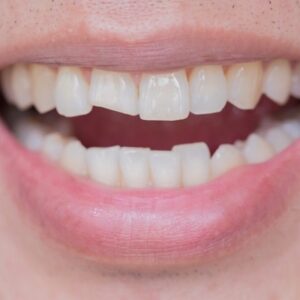 Cost of Teeth Fracture Treatment in Islamabad & Pakistan