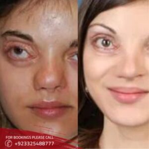 Burn Reconstructive Surgery in Islamabad, Rawalpindi and Pakistan