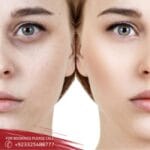 Organic Fillers in Islamabad, Rawalpindi & Pakistan