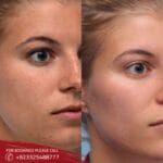 Organic Fillers in Islamabad, Rawalpindi & Pakistan